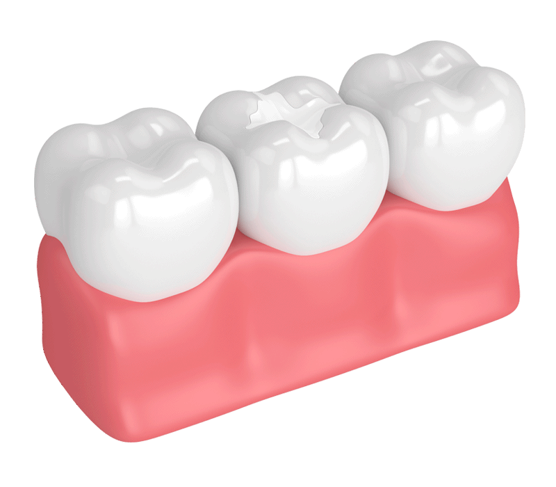 White Fillings – Aesthetic, Durable & Tooth-Preserving Restorations